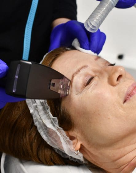 Neck (Platysmal) Bands - Perfect Skin Solutions