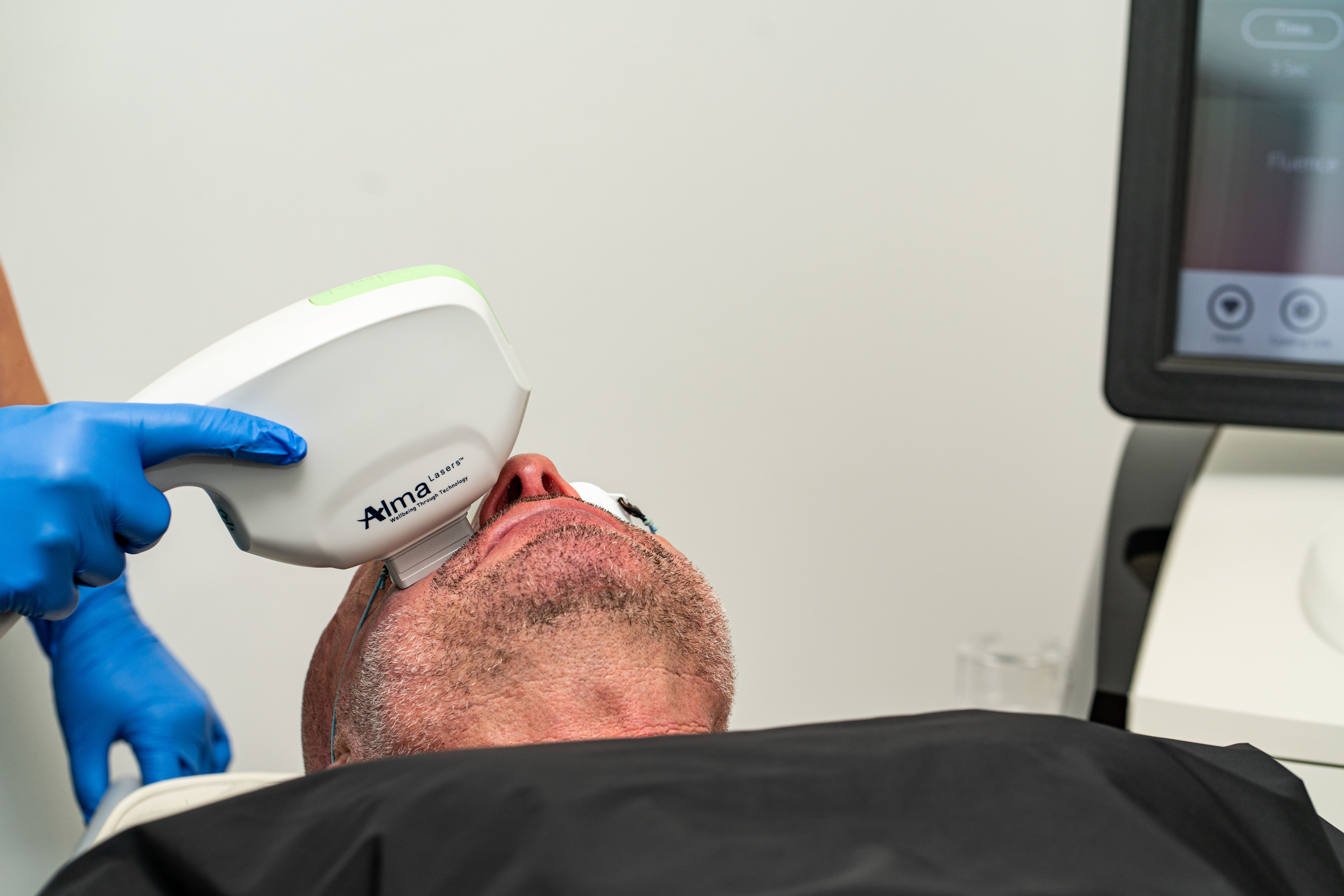 IPL Intense Pulsed Light | Before & After | Perfect Skin Solutions