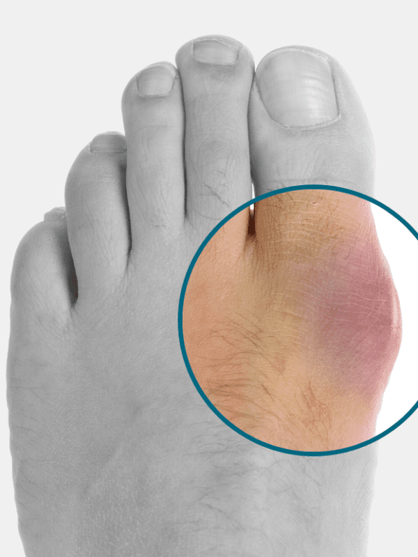 Foot Fillers - Perfect Skin Solutions