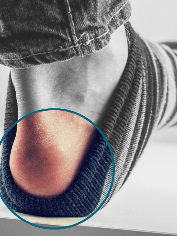 Foot Fillers - Perfect Skin Solutions