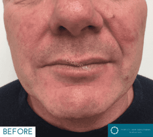 IPL - Perfect Skin Solutions