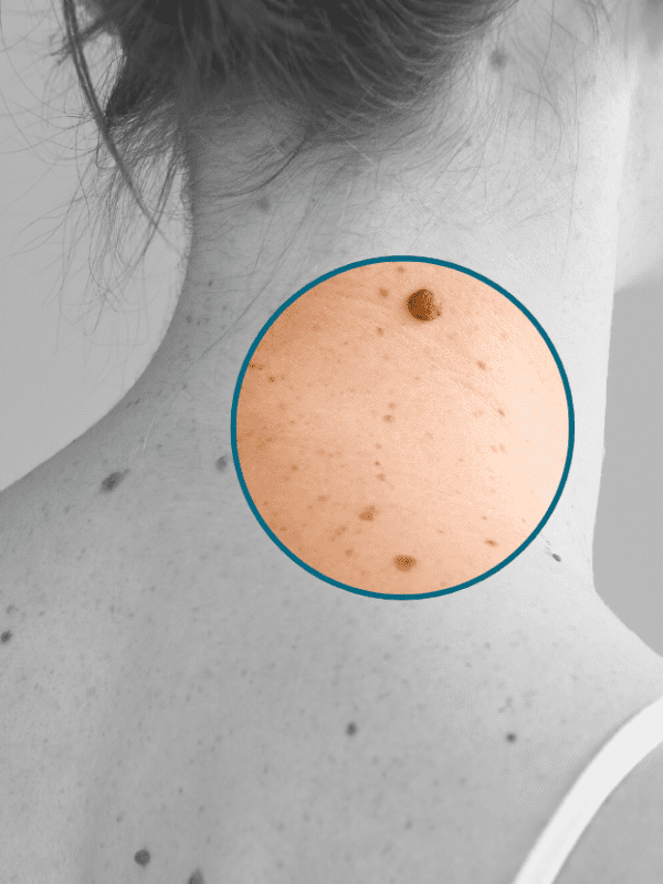 Lumps, bumps & lesion removal - Perfect Skin Solutions