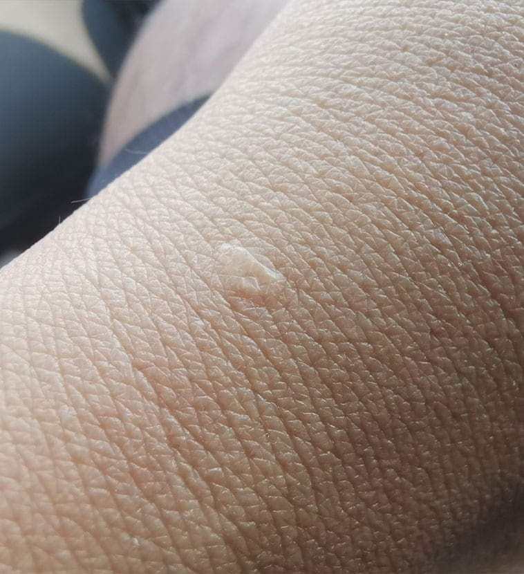 Scarring - Perfect Skin Solutions