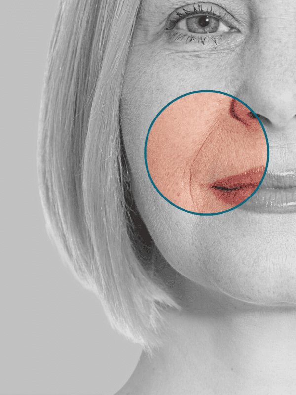 Neck (Platysmal) Bands - Perfect Skin Solutions