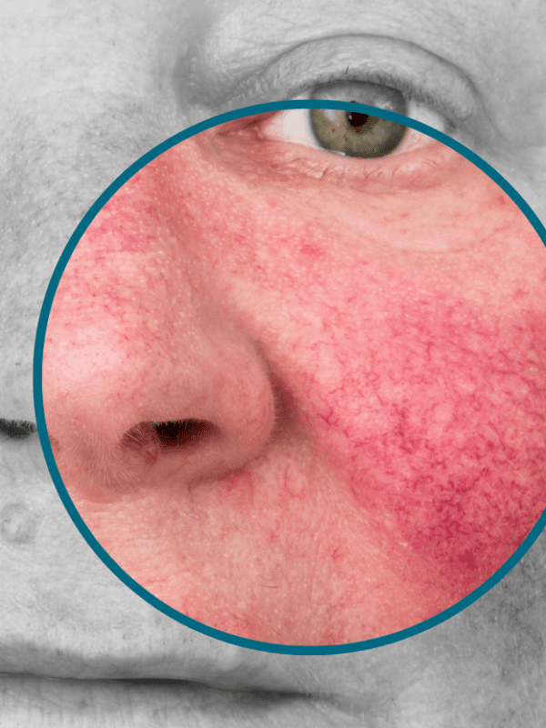 Dermalux Tri-Wave MD - NEW! - Perfect Skin Solutions