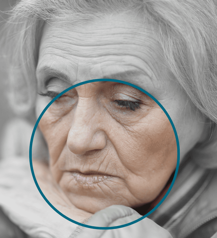 Facial volume loss - Perfect Skin Solutions