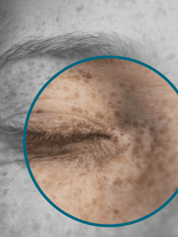 Exosomes Treatment | Exosome Therapy for Skin Rejuvenation | Perfect ...