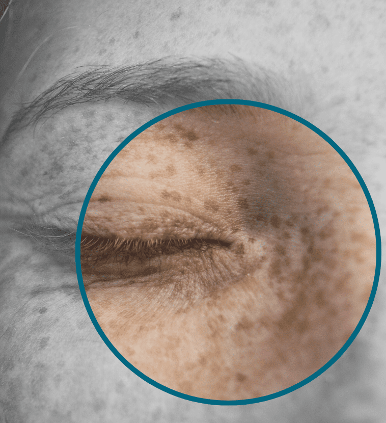 Understanding Pigmentation on Neck: Causes, Treatment, and Solutions