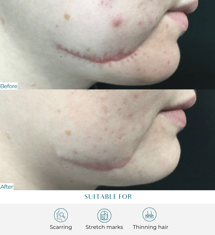 iPRF - Injectable Platelet Rich Plasma | Before & After Photos