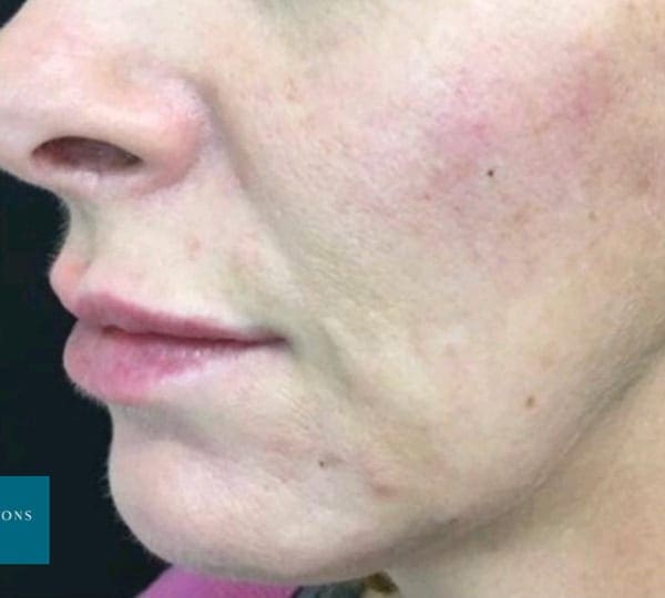 Jawline Fillers - Perfect Skin Solutions