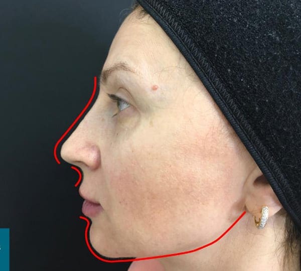 Jawline Fillers - Perfect Skin Solutions