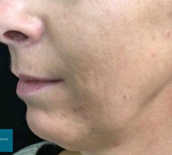 Jawline Fillers - Perfect Skin Solutions