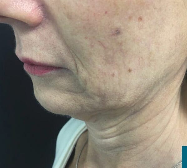 Jawline Fillers - Perfect Skin Solutions