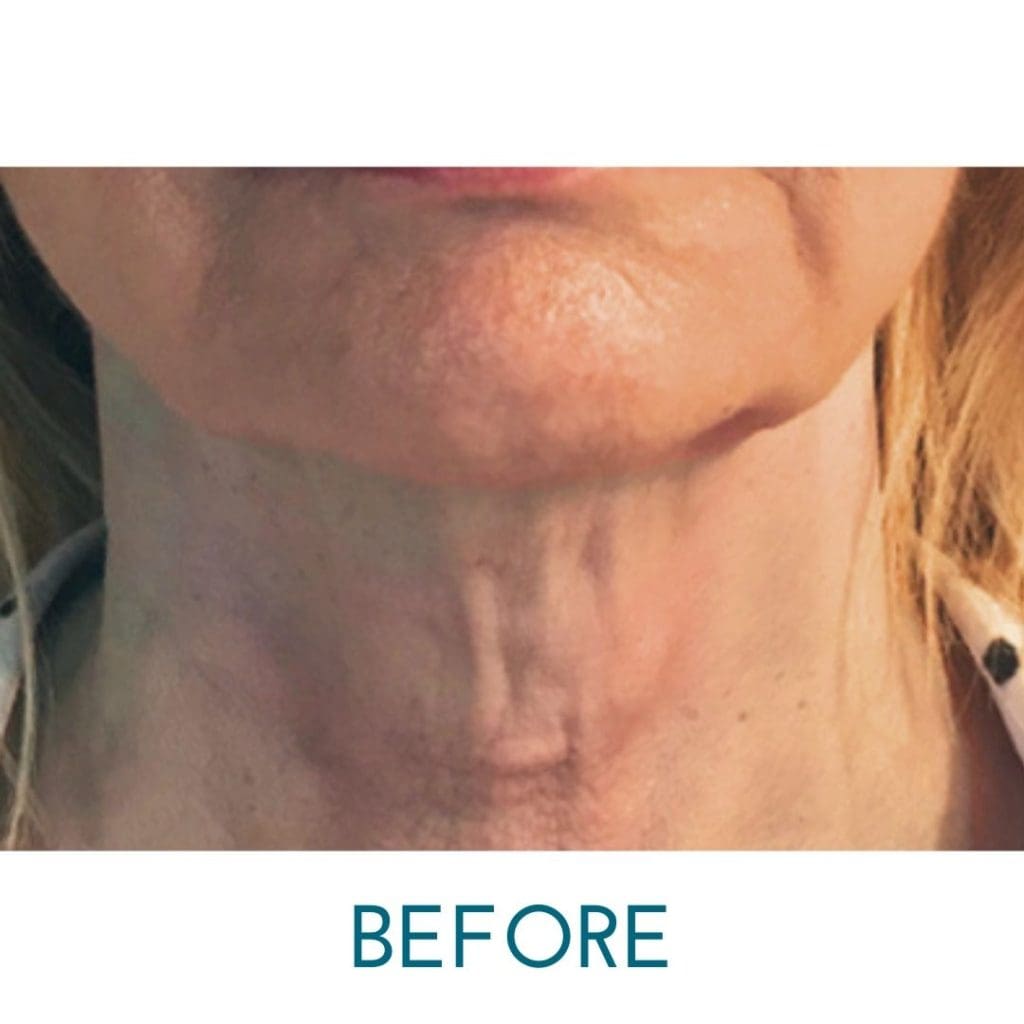 EndoLift - NEW! - Perfect Skin Solutions