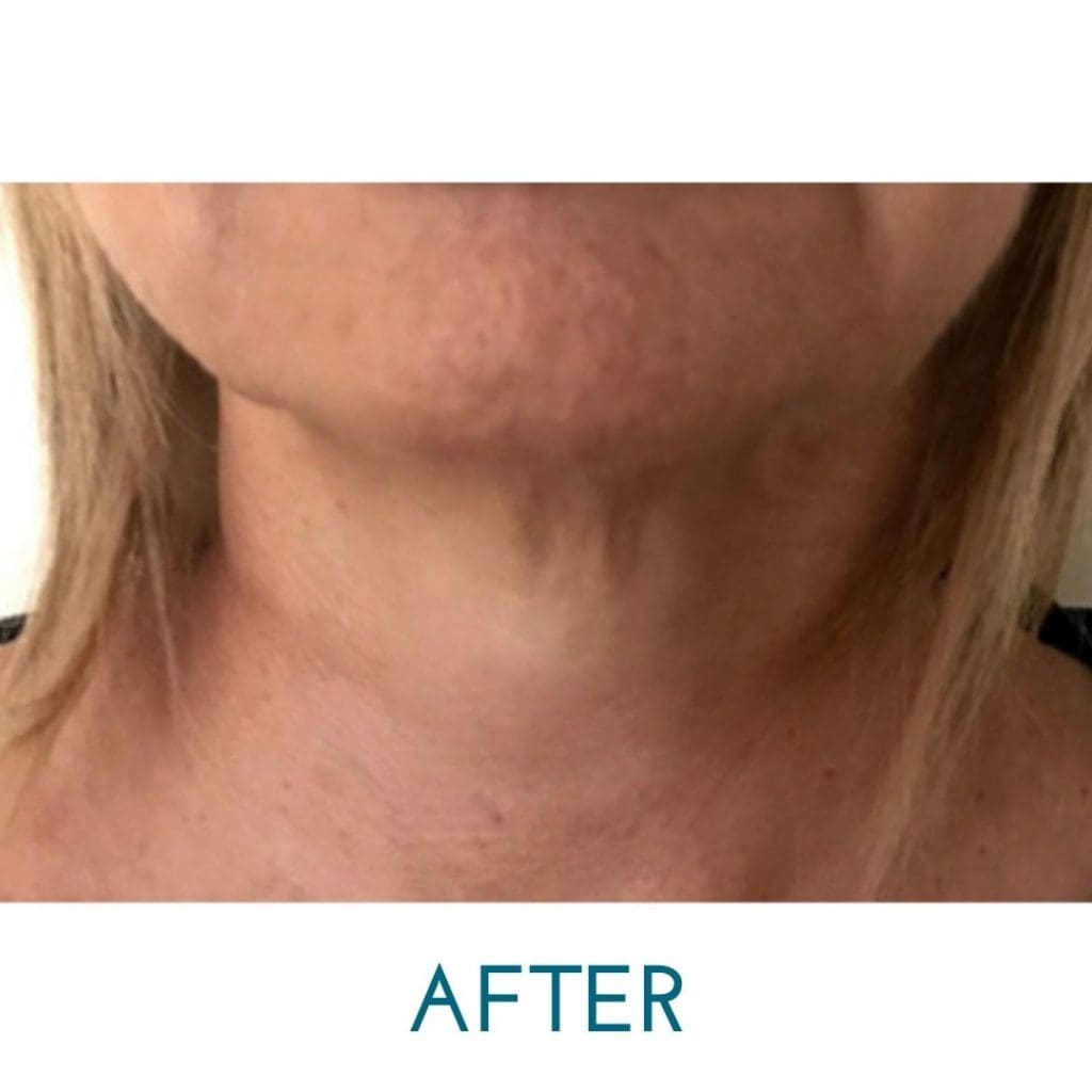 EndoLift - NEW! - Perfect Skin Solutions