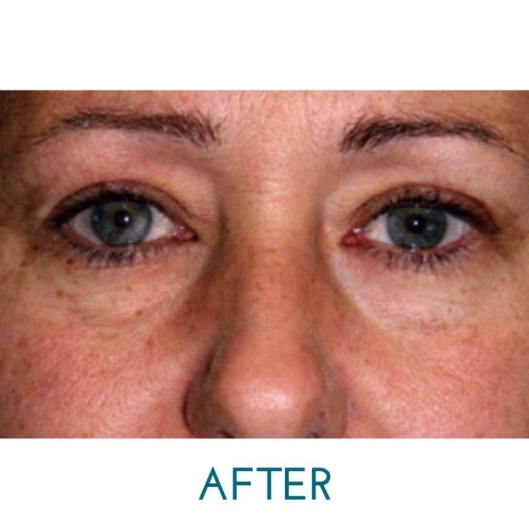 EndoLift - NEW! - Perfect Skin Solutions