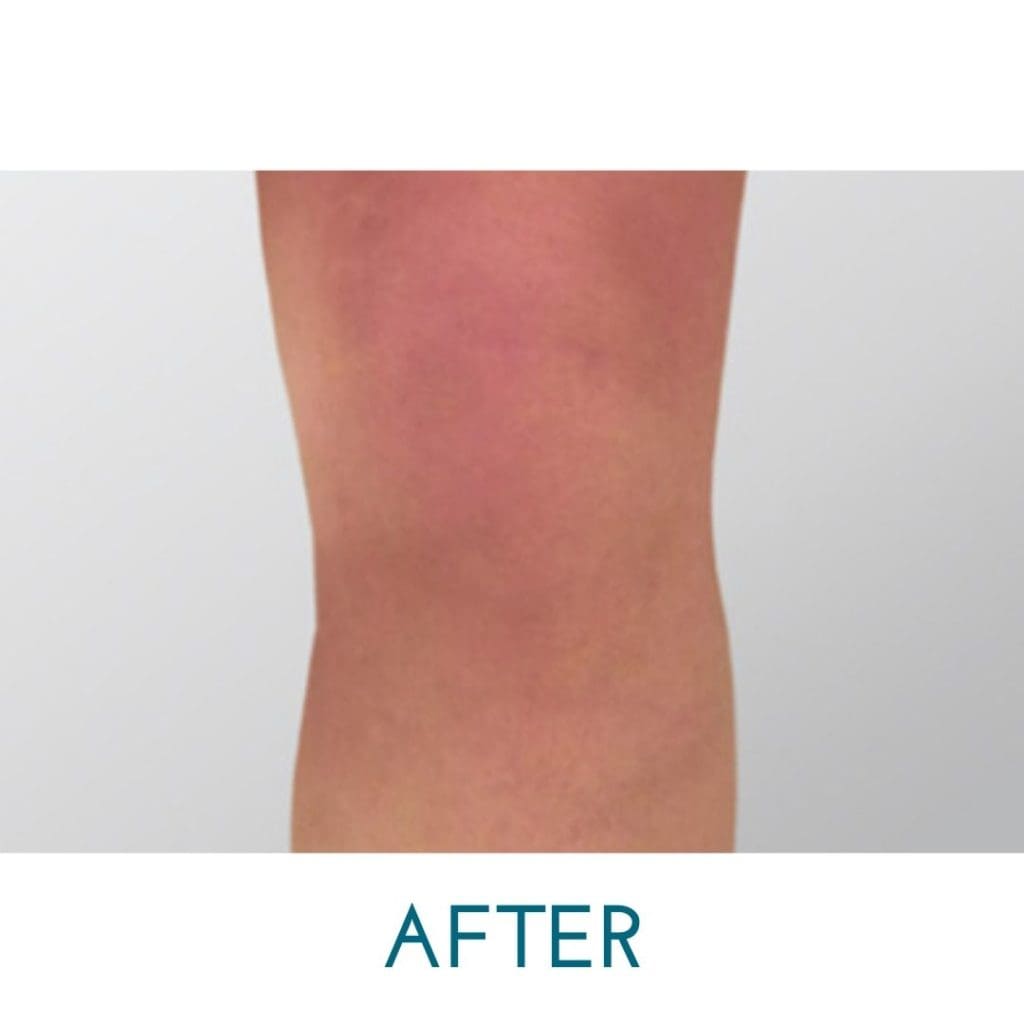 EndoLift - NEW! - Perfect Skin Solutions