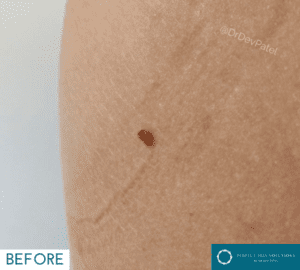 Skin Tags & Blemishes Removal | Before & After Photos | Perfect Skin ...