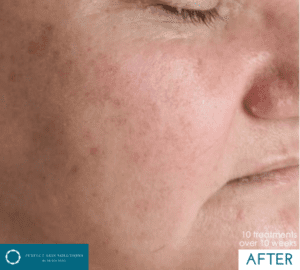 Dermalux Tri-Wave MD - NEW! - Perfect Skin Solutions