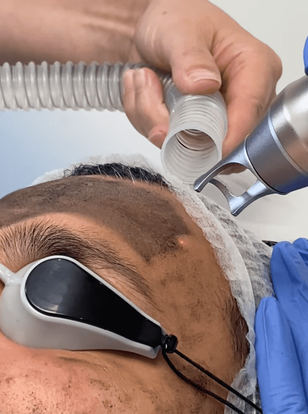 PicoMax Laser Tattoo Removal - Perfect Skin Solution Portsmouth