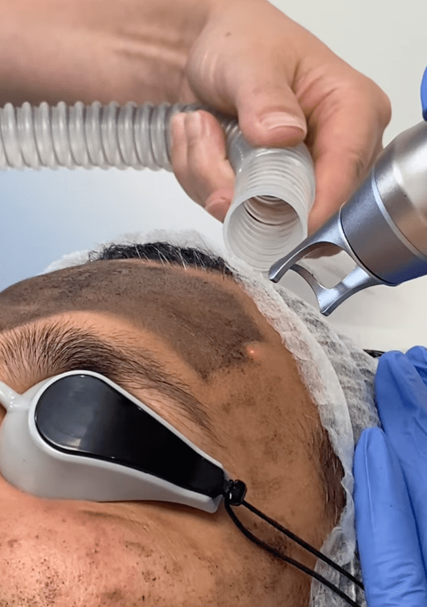 PicoMax Laser Treatments | Perfect Skin Solution Portsmouth