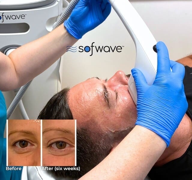 Sofwave Brow/Neck/FaceLift | Before & After Photos