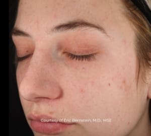 UltraClear From £450: Cold Fibre Laser Technology at Perfect Skin Solutions