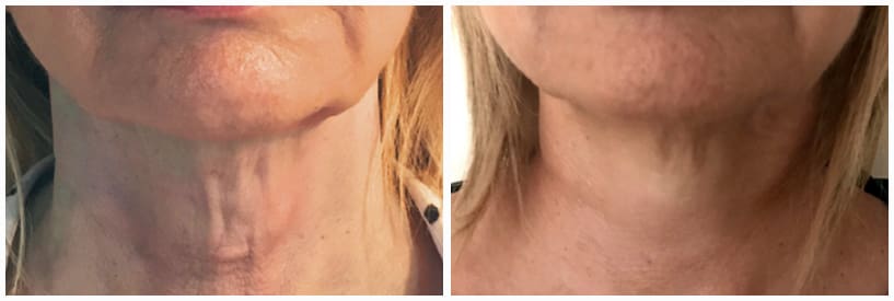 Ultimate Guide to Treating Wrinkly Neck Skin: Solutions for a Youthful Neck