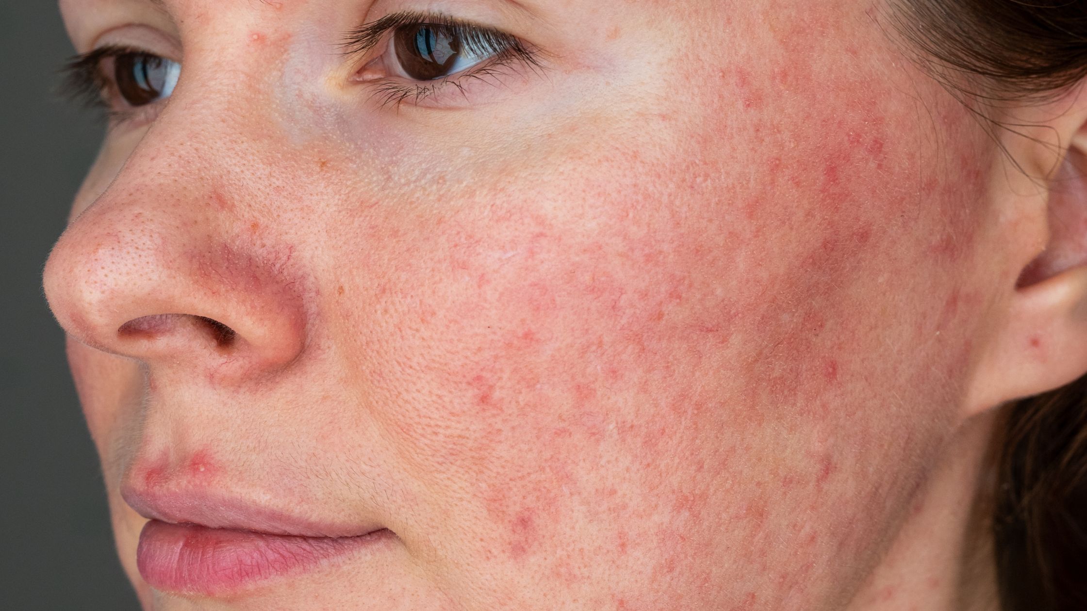 How to Clear Spots: Effective Tips for Acne Treatment at Home