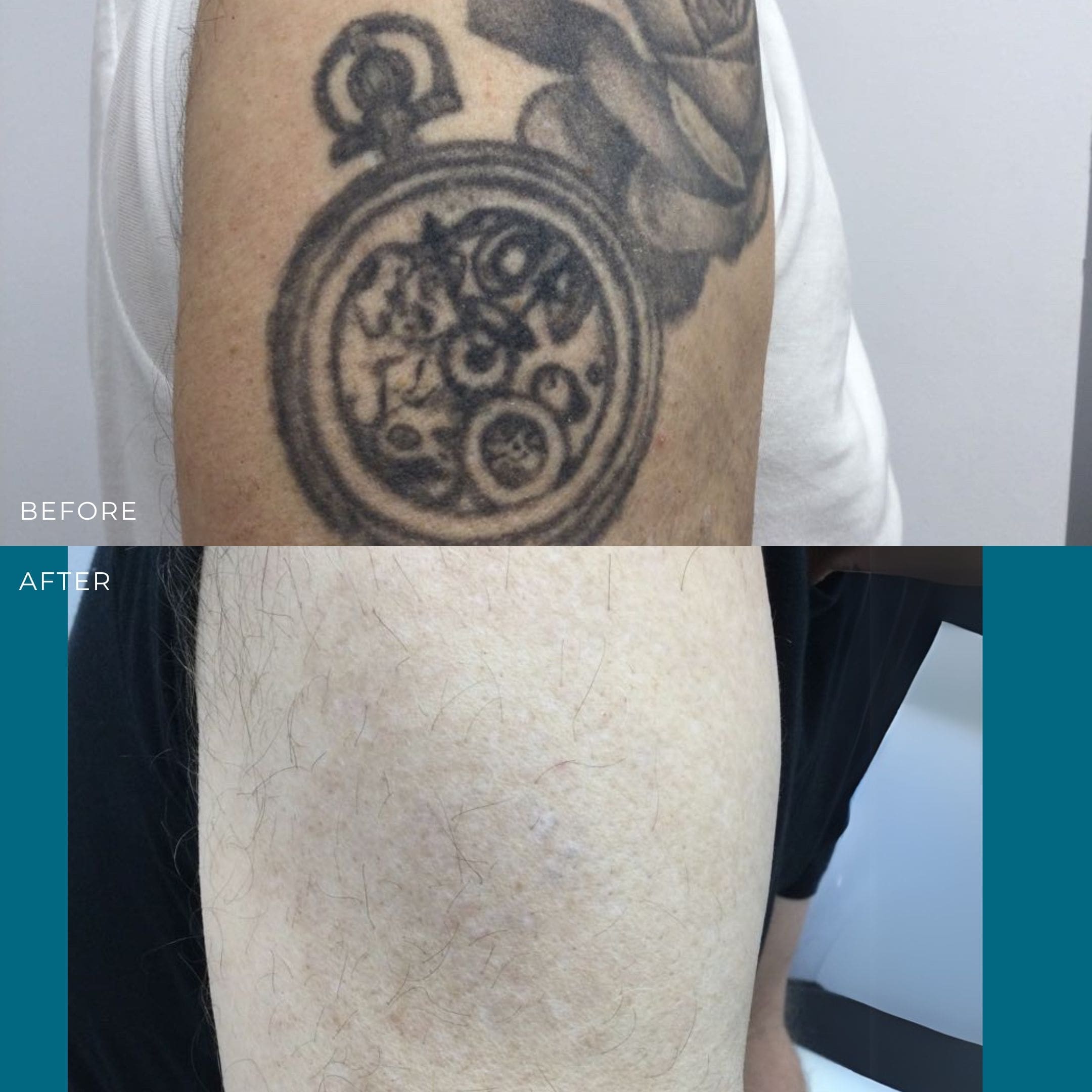 Complete tattoo removal - Bronctattooaus.com